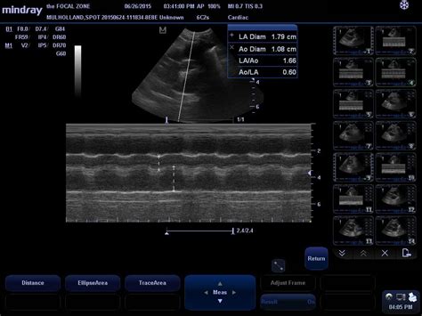 Restrictive Cardiomyopathy Vs Dilated Cardiomyopathy In An 11 Year Old