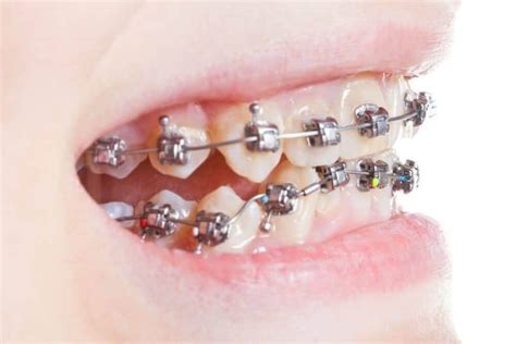 An Easy Guide To Interproximal Reduction Ipr For Braces
