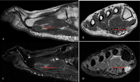 Figure 1 From Synovial Sarcoma Of The Foot As An Atypical Cause Of Persistent Metatarsalgia