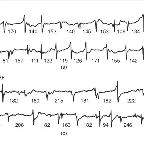 Pdf Processing Of Intracardiac Electrograms In Atrial Fibrillation Diagnosis Of
