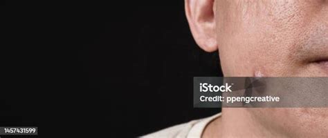 Bacterial Skin Infection Big Acne Cyst Abscess Or Ulcer Swollen Area Within Face Skin Tissue