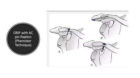 Ac Joint Dislocationpptx Death Injury Or Military Conflict Sensitive Topics