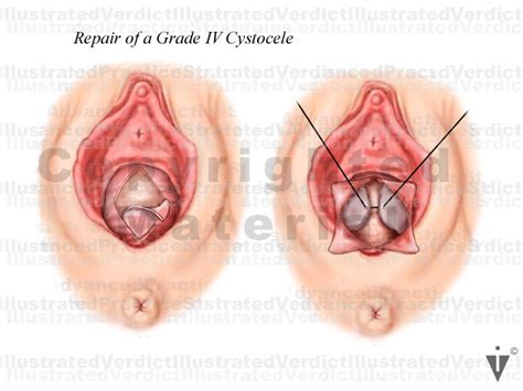 Stock Female Pelvis Prolapse Rectocele Cystocele — Illustrated Verdict
