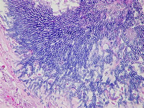 Aspergillosis Histology