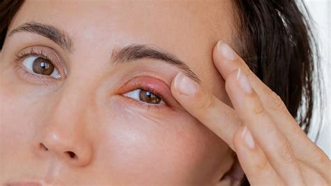 Orbital Cellulitis Vs Preseptal Cellulitis Key Differences