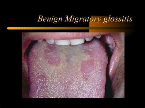 Developmental Disorders Of Orofacial Structures Dental Oral Pathology