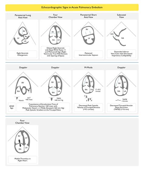 Acute Pulmonary Embolism Pe Part 2 Md Nexus