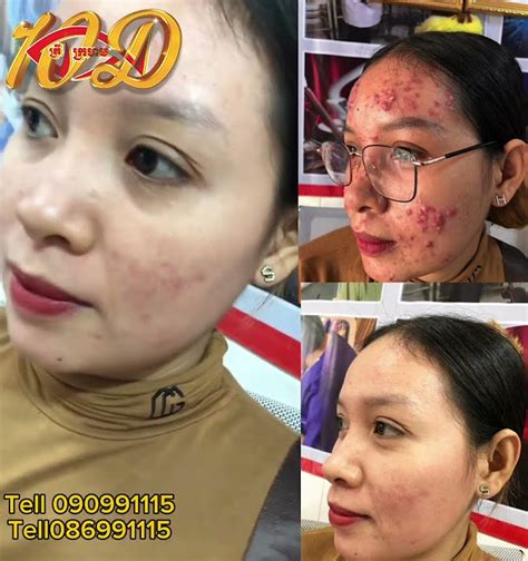 ត្រីក្រហម ព្យាបាលរាល់បញ្ហាមុនកើតមុន Telegram 0716388883 Youtube