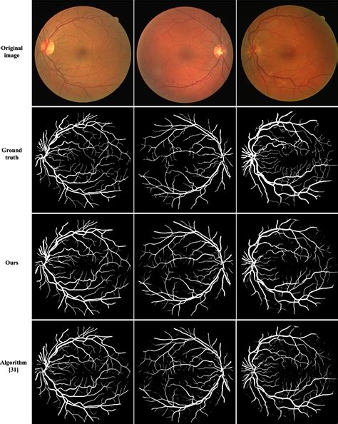 Figure 6 From Retinal Vascular Segmentation Network Based On Multi