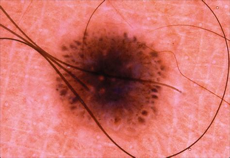 Dermoscopy Of Pigmented Spitz And Reed Nevi The Starburst Pattern