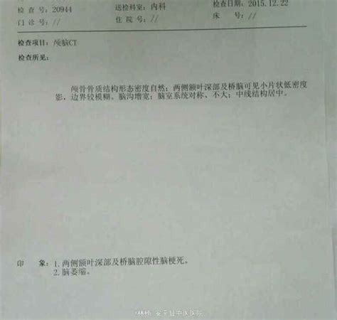 进展型脑梗塞1例 医联