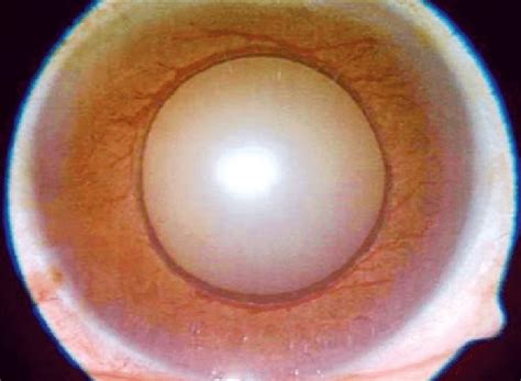 Regressing Iris Neovascularization Following Bevacizumab Injection Download Scientific Diagram