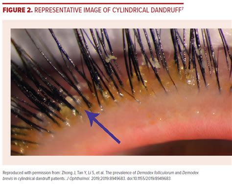 Navigating The Challenges Of Diagnosing And Managing Demodex Blepharitis