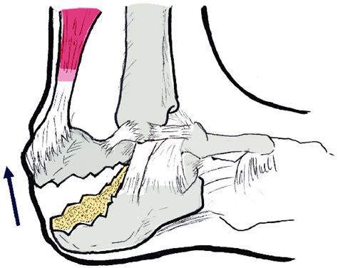 Tongue Type Calcaneal Fractures Are Longitudinal Fractures That Involve