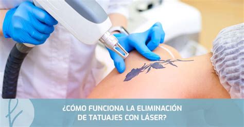 ¿cómo Funciona La Eliminación De Tatuajes Con Láser