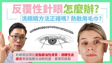 針眼反覆發作怎麼辦第一次長針眼除了吃抗生素熱敷只能用毛巾嗎 清洗眼睛不可缺少的法寶擺脫反覆性針眼 YouTube