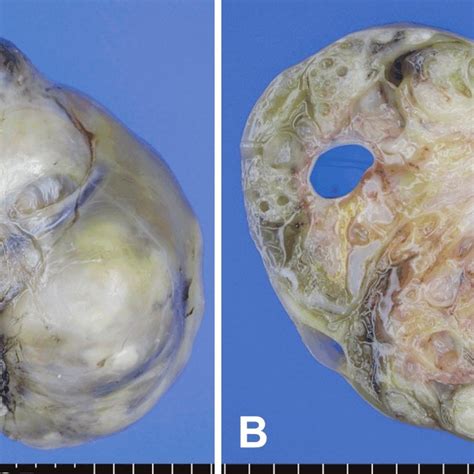 Photographs Of The Immature Gastric Teratoma A Gross Specimen B Download Scientific