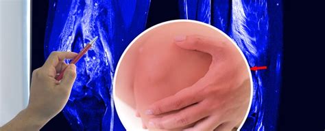 Osteosarkom Blic Zdravlje