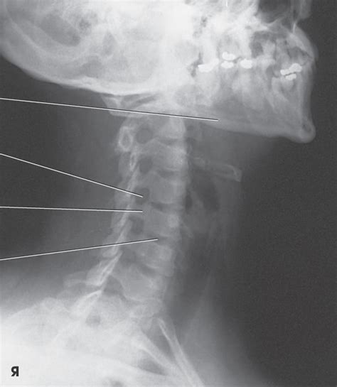 Pos 2 Rao C Spine Diagram Quizlet