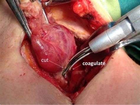 Ligation Of The Inferior Thyroid Vessels With A Double Ligation