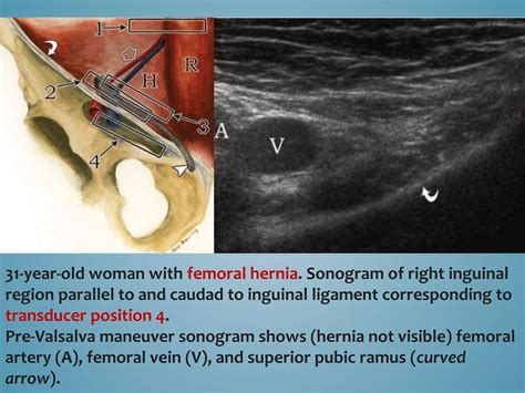 Ultrasoud Hernia Pptx