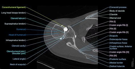 Ct Arthrogram Of The Shoulder Joint Normal Anatomy E Anatomy