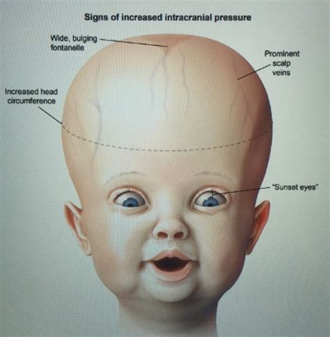 46 Cerebral Dysfunction Flashcards Quizlet