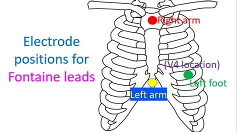 Epsilon Wave All About Cardiovascular System And Disorders