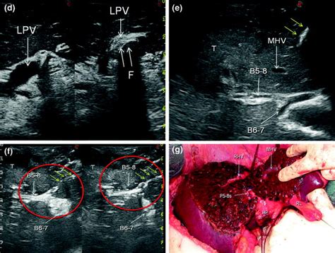 Intraoperative Cholangio Ultrasound In The Study Of The Biliary Tree