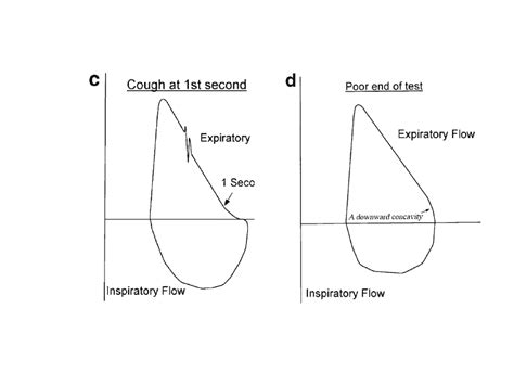 Spirometry Interpretation Ppt