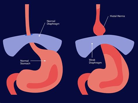 Hernia Types Hiatal Hernias