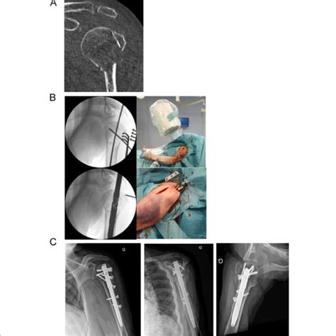 Female Patient 79 Years 3 Part Fracture Of The Proximal Humerus 1a Download Scientific