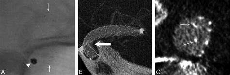 A Left Anterior Oblique DSA Image At Months After Intracranial Download Scientific Diagram