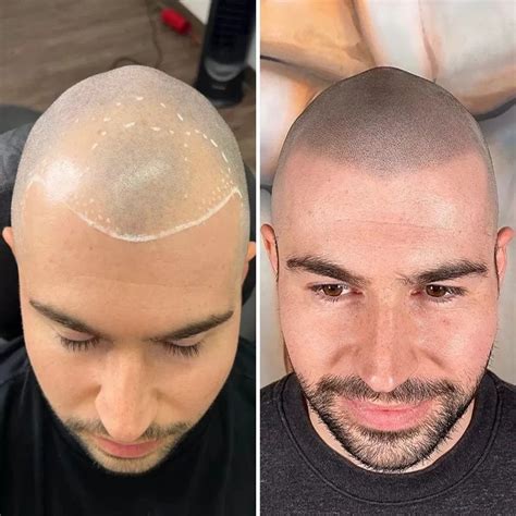 Scalp Micropigmentation Aesthetics Beauty Laser