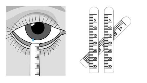 Tests For Diagnosing Dry Eye Syndrome Eye Health Nepal