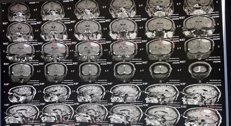 Left Parietal Craniotomy And Tumor Excision Medicover Hospitals