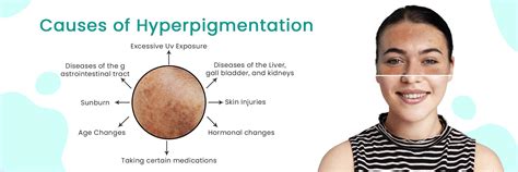 Hyperpigmentation Pigmentationin