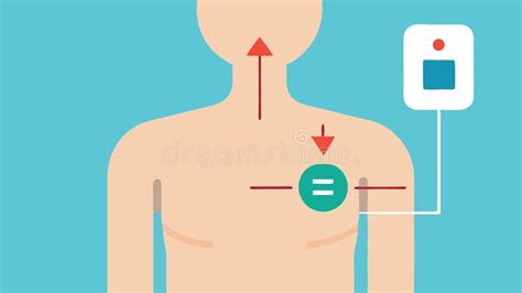 Glucose Sensor Application A Vector Showing The Application Of A Glucose Sensor On The Skin With