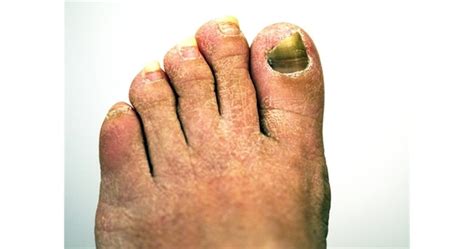 Есента буди гъбичките по краката