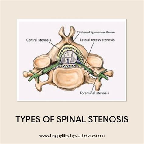 Left Lateral Recess Stenosis