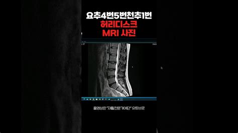 요추4번5번 천추1번 허리디스크 환자 MRI 사진 YouTube