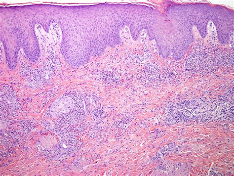 Blastomycosis Dermatopathology