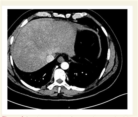 Figure 1 From The Role Of Multi Modality Cardiovascular Imaging In A