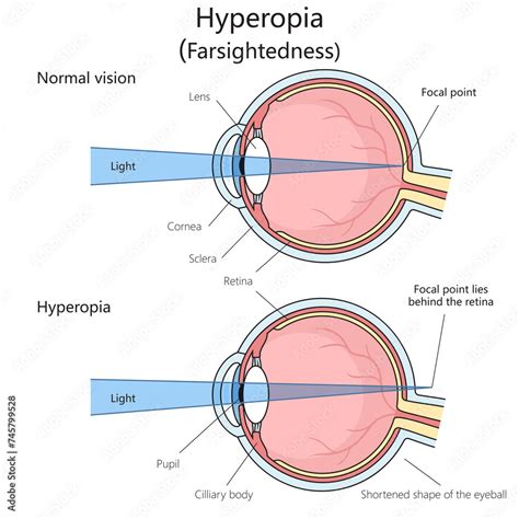 Farsightedness Hypermetropia Hyperopia Structure Diagram Hand Drawn