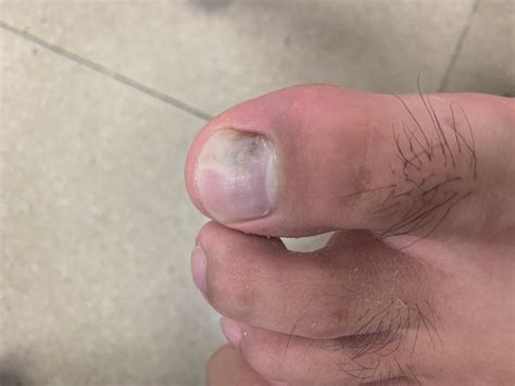 발톱 멍 든후 지식in