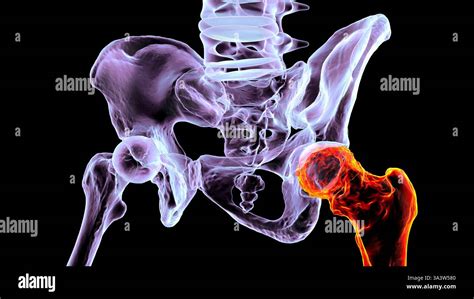 Illustration Of Hip Osteoarthritis Showing Joint Degeneration