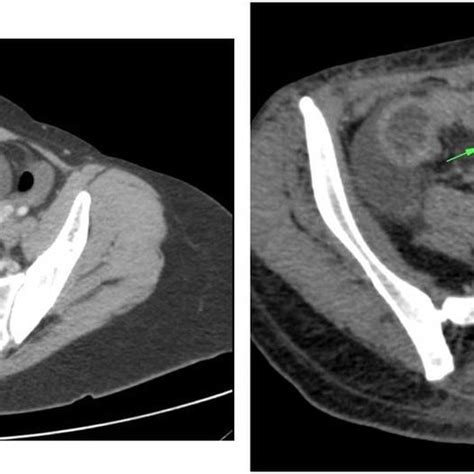 Ileocolic Resection Showing An Edematous Terminal Ileum With Download Scientific Diagram