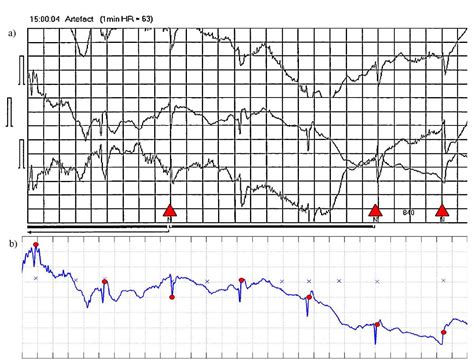 Qrs Complex Detection In Noisy Holter Ecg Based On Wavelet