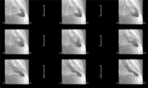 Ventriculography Showing Hypokinesia In The Inferoapical Wall Of The Heart Download Ventriculography Showing Hypokinesia In The Inferoapical Wall Of The Heart Download