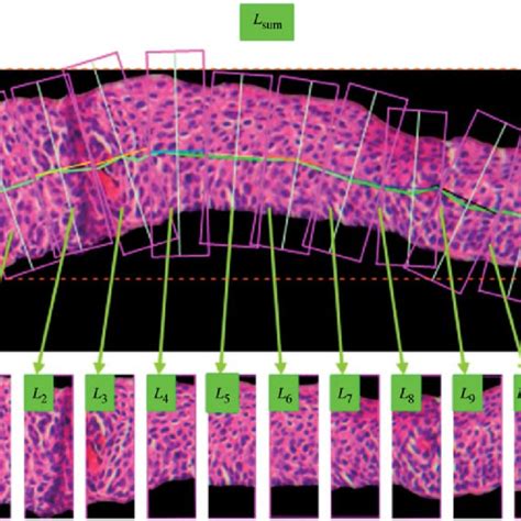 The Cin Grading Image Samples A Normal B Cinii C Ciniii D Download Scientific